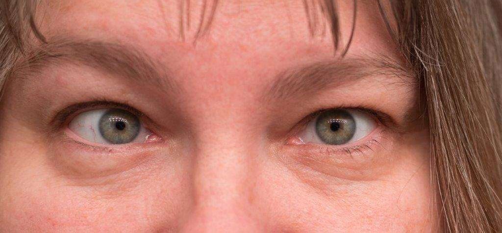 Amblyopia Lazy Eye Revere Optical Revere Optical